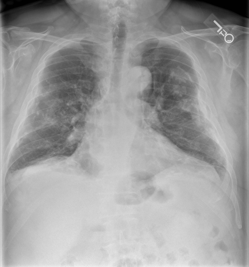 Asbestos Related Pleural Disease – Pleural Plaques and The Holly Leaf ...