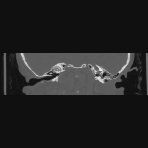 Cochlear Otosclerosis – RADIOLOGYPICS.COM