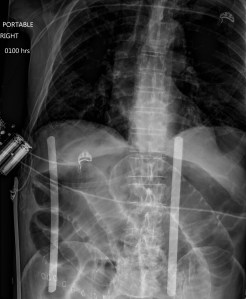 Pneumoperitoneum – Rigler Sign – RADIOLOGYPICS.COM