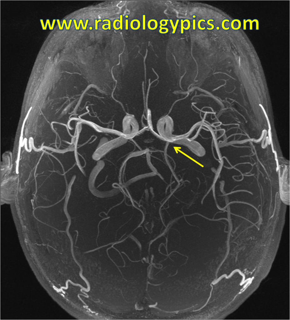 Fetal Origin of the Posterior Cerebral Artery – My Brain MRI ...