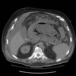 Pancreatic Abscess or Walled off Necrosis - Pediatric Teleradiology