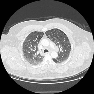 Paraseptal Emphysema - Pediatric Teleradiology