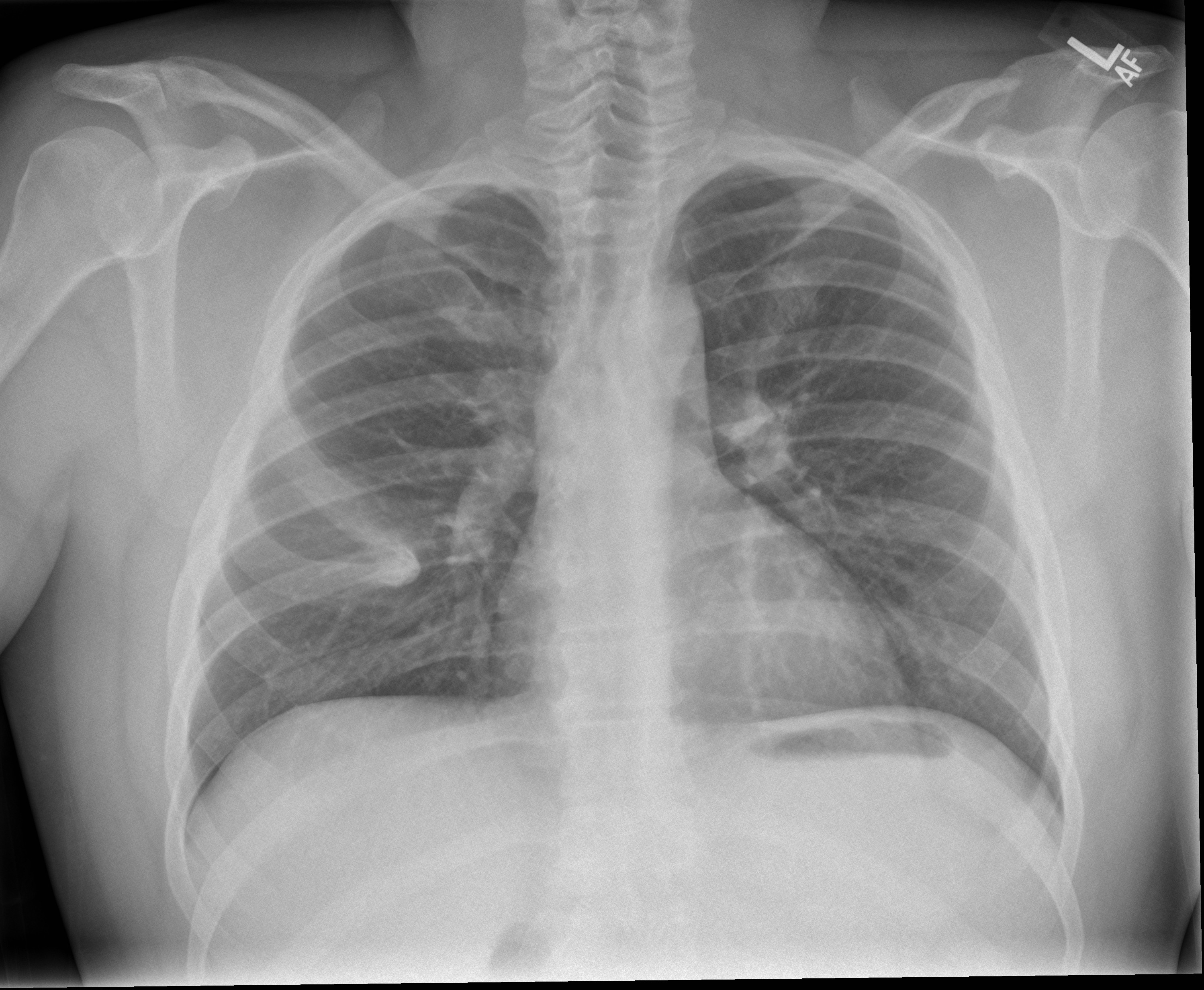 Fused Rib or Rib Synostosis – RADIOLOGYPICS.COM