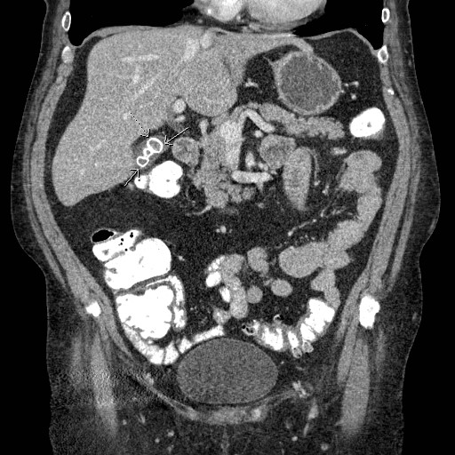 Cholelithiasis – RADIOLOGYPICS.COM