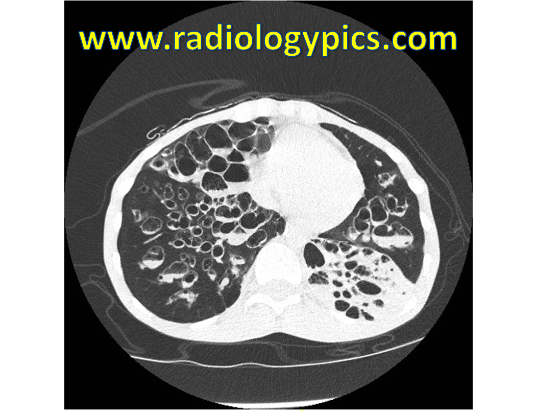 Bronchiectasis – Differential Diagnosis – RADIOLOGYPICS.COM
