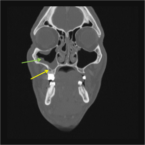 Periapical Tooth Abscess - The spectrum of apical periodontitis ...