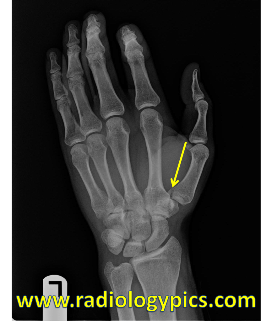 Solution to Unknown Case #25 – Bennett Fracture – RADIOLOGYPICS.COM