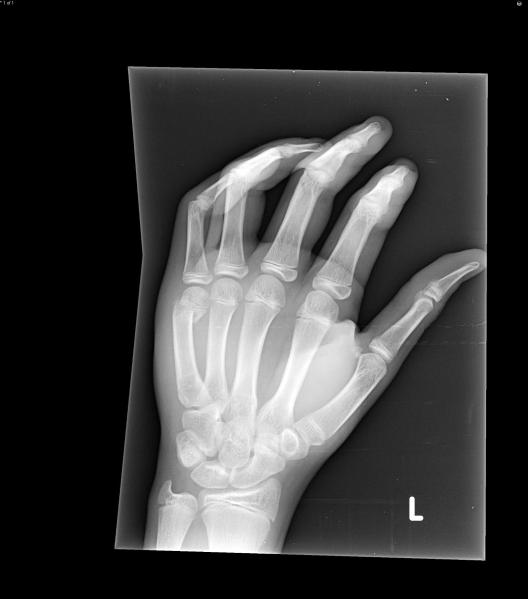 Unknown Case # 10 – Pediatric Hand Radiograph – RADIOLOGYPICS.COM