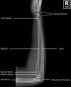 Radiographic Anatomy of the Forearm – RADIOLOGYPICS.COM