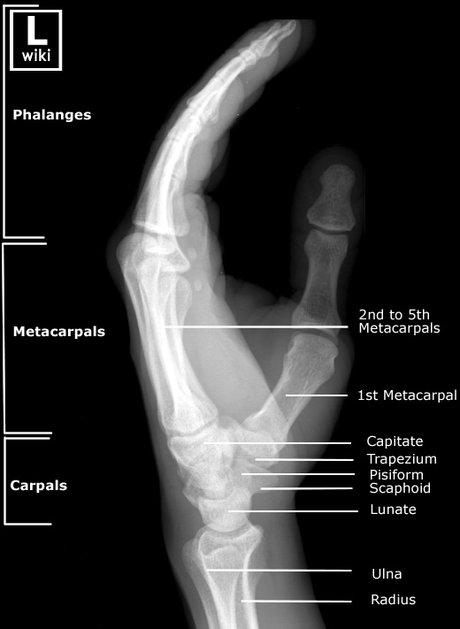 Radiographic Anatomy of the Hand – RADIOLOGYPICS.COM