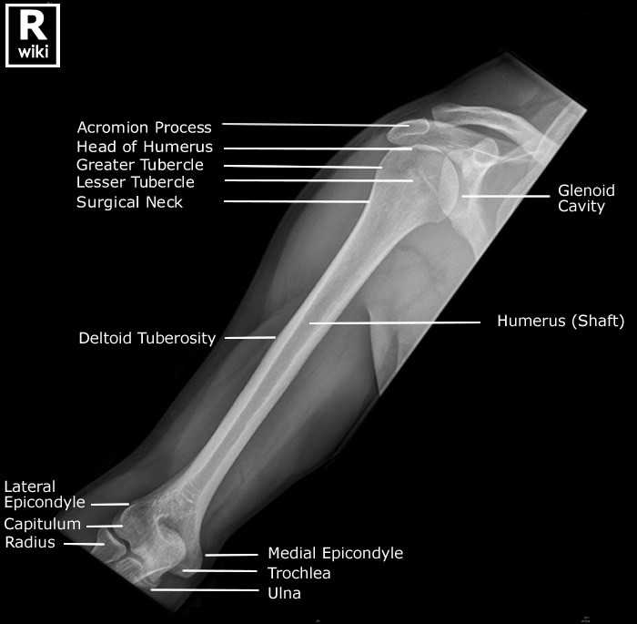 Radiographic Anatomy of the Humerus – RADIOLOGYPICS.COM