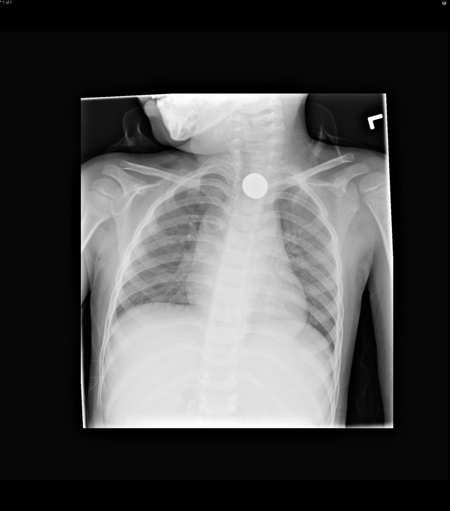 Pediatric Foreign Body Ingestion – RADIOLOGYPICS.COM