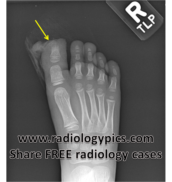 Big Toe Crush Injury – RADIOLOGYPICS.COM