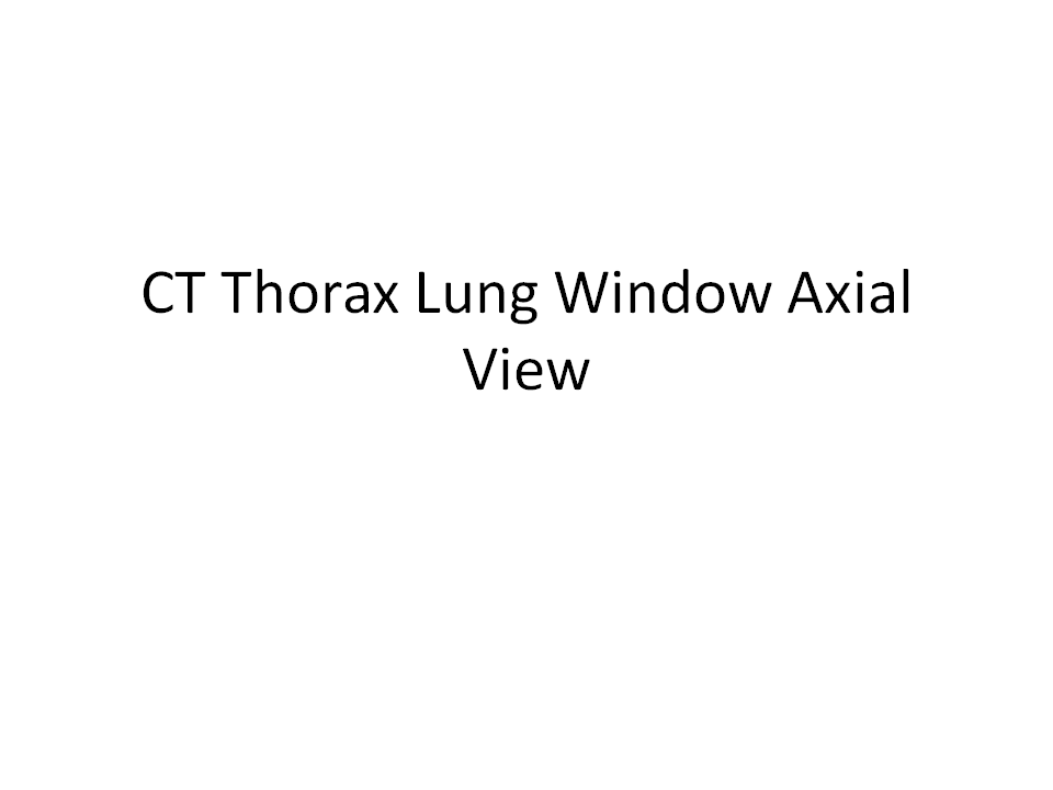 CT of the Chest Lung Windows Axial Anatomy – RADIOLOGYPICS.COM