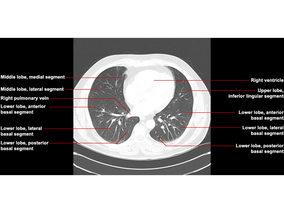 CT of the Chest Lung Windows Axial Anatomy – RADIOLOGYPICS.COM