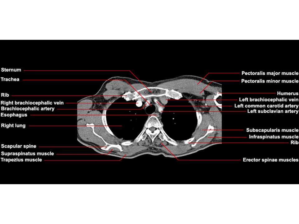 CT of the Chest Soft Tissue Windows Axial Anatomy – RADIOLOGYPICS.COM