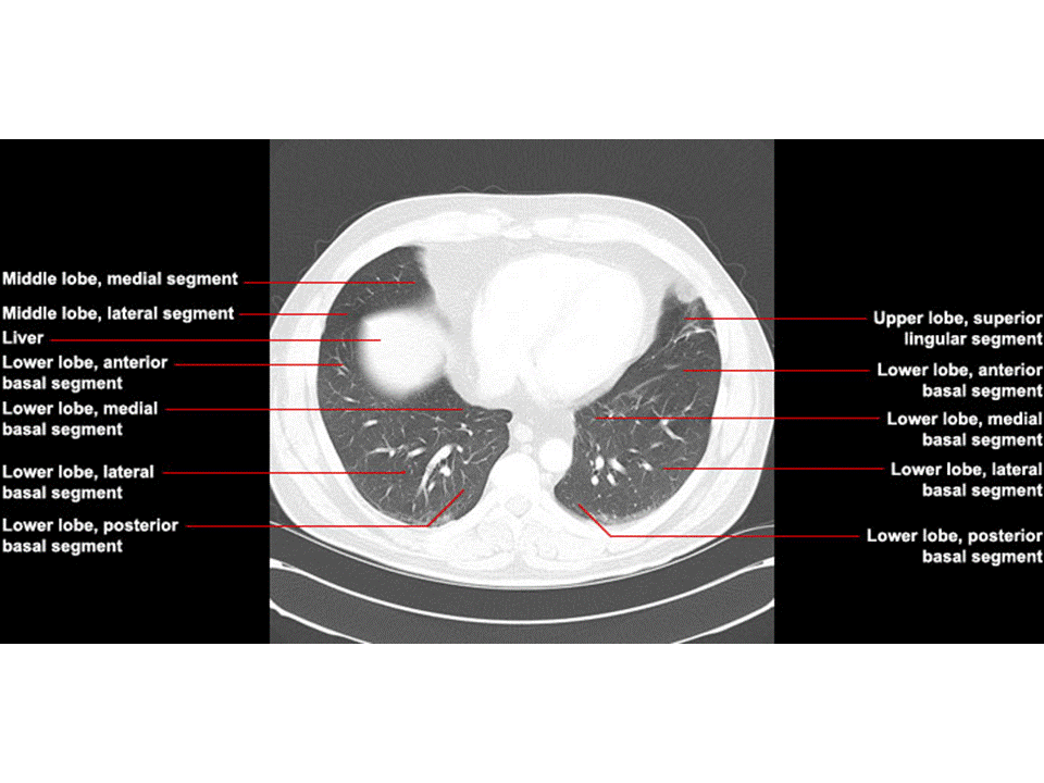 CT of the Chest Lung Windows Axial Anatomy – RADIOLOGYPICS.COM