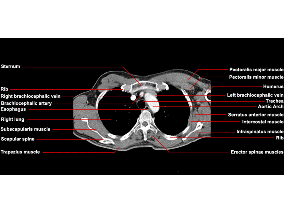 CT of the Chest Soft Tissue Windows Axial Anatomy – RADIOLOGYPICS.COM