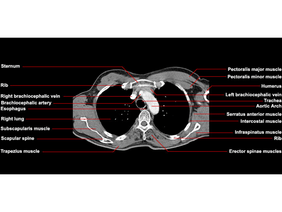 CT of the Chest Soft Tissue Windows Axial Anatomy – RADIOLOGYPICS.COM