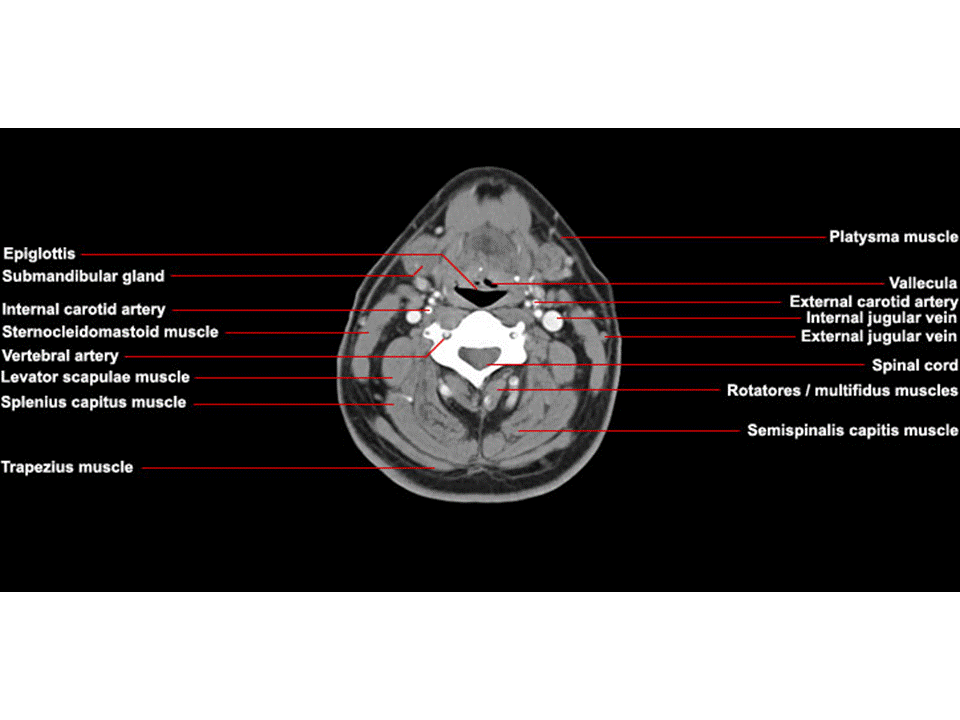 CT Neck Axial Anatomy – RADIOLOGYPICS.COM