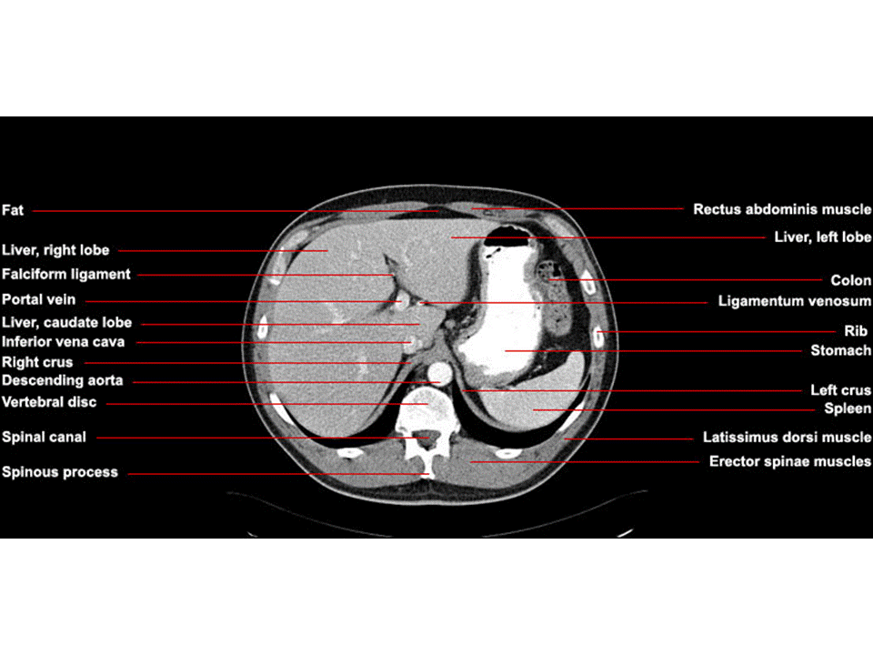 CT of the Abdomen Axial Anatomy – RADIOLOGYPICS.COM