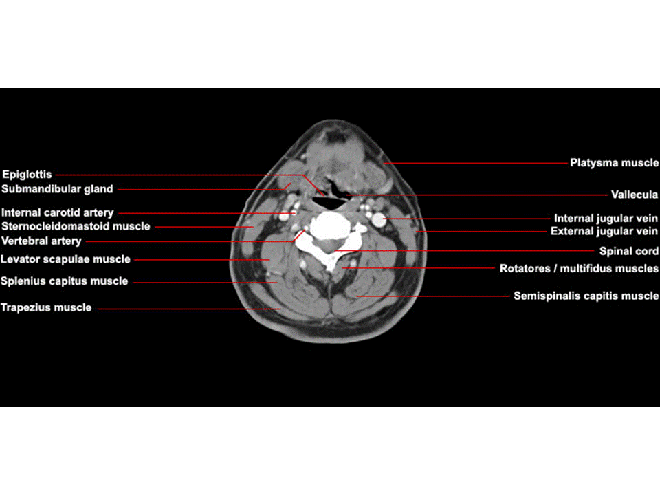 CT Neck Axial Anatomy – RADIOLOGYPICS.COM
