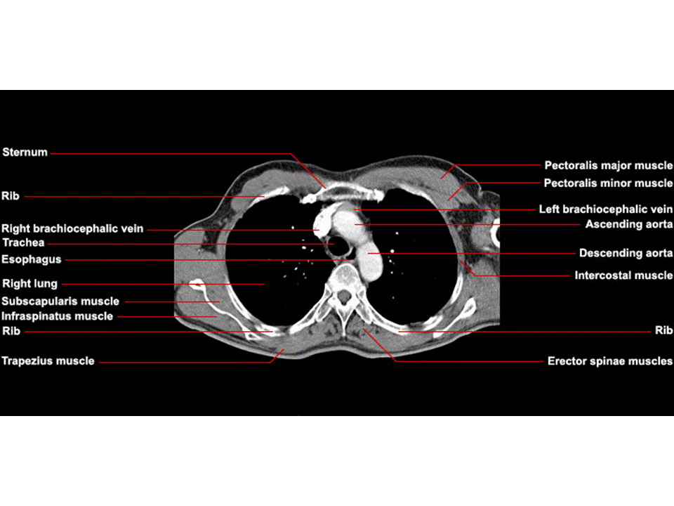 CT of the Chest Soft Tissue Windows Axial Anatomy – RADIOLOGYPICS.COM
