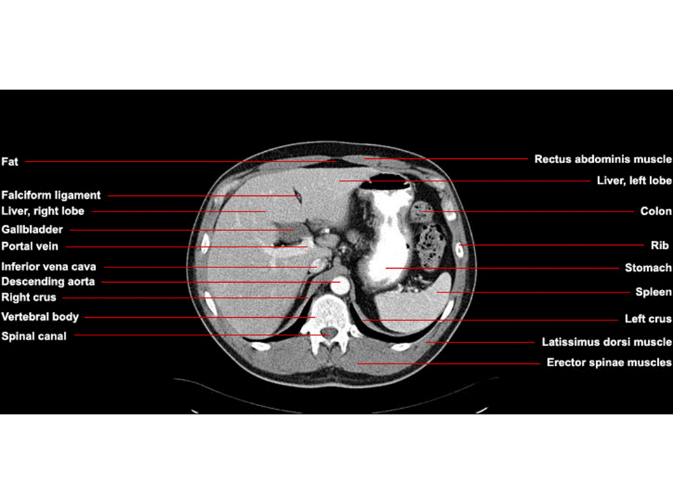 CT of the Abdomen Axial Anatomy – RADIOLOGYPICS.COM
