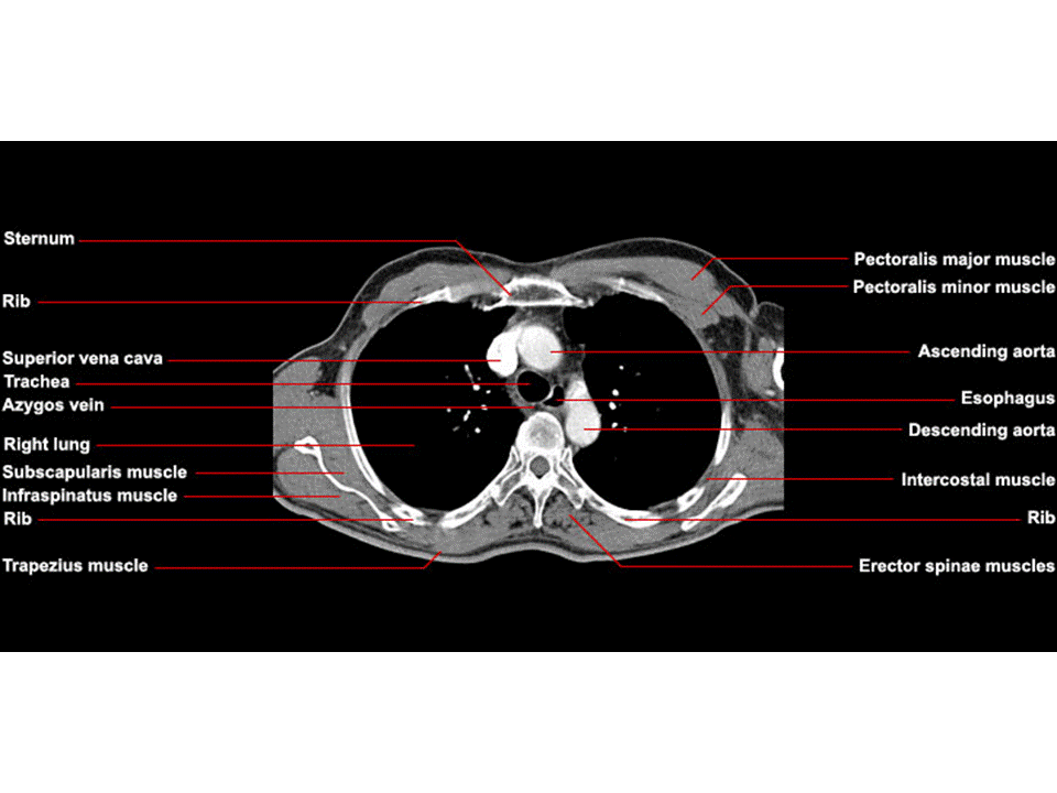 CT of the Chest Soft Tissue Windows Axial Anatomy – RADIOLOGYPICS.COM
