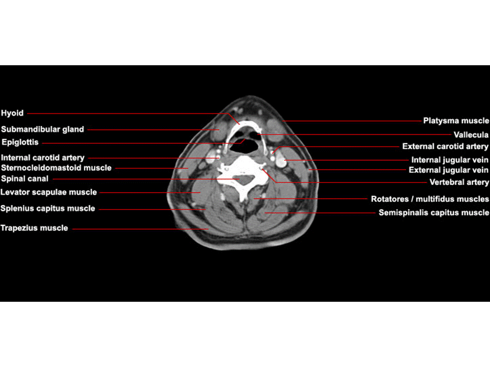 CT Neck Axial Anatomy – RADIOLOGYPICS.COM