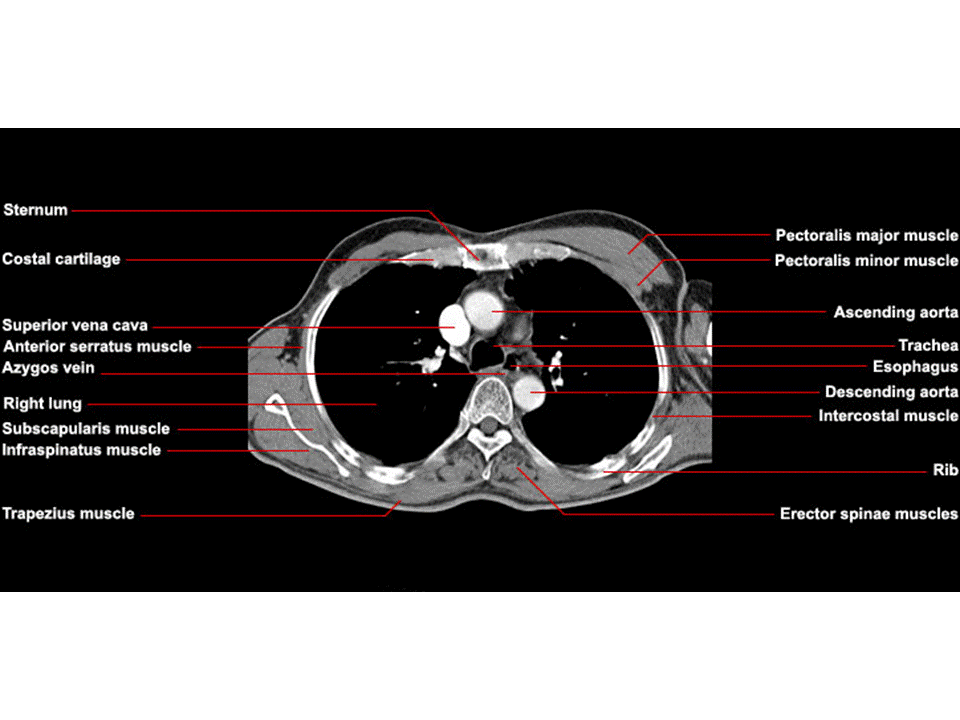 CT of the Chest Soft Tissue Windows Axial Anatomy – RADIOLOGYPICS.COM