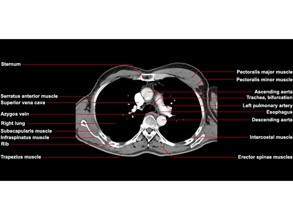 CT of the Chest Soft Tissue Windows Axial Anatomy – RADIOLOGYPICS.COM
