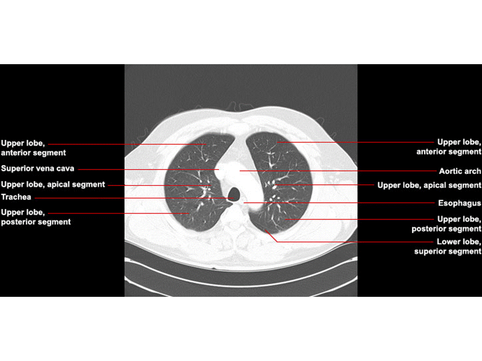 CT of the Chest Lung Windows Axial Anatomy – RADIOLOGYPICS.COM