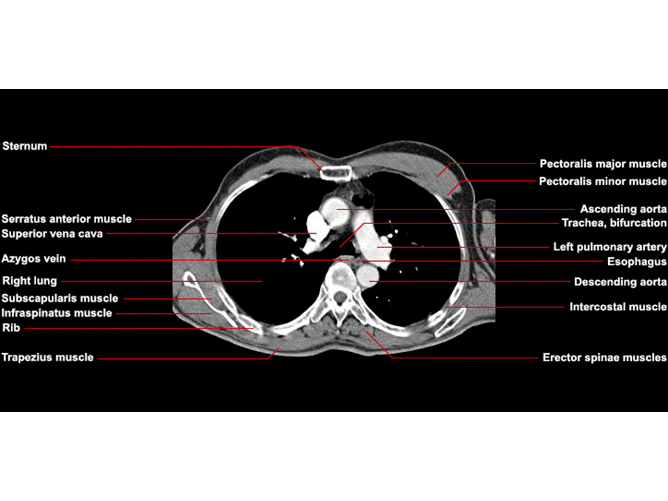 CT of the Chest Soft Tissue Windows Axial Anatomy – RADIOLOGYPICS.COM