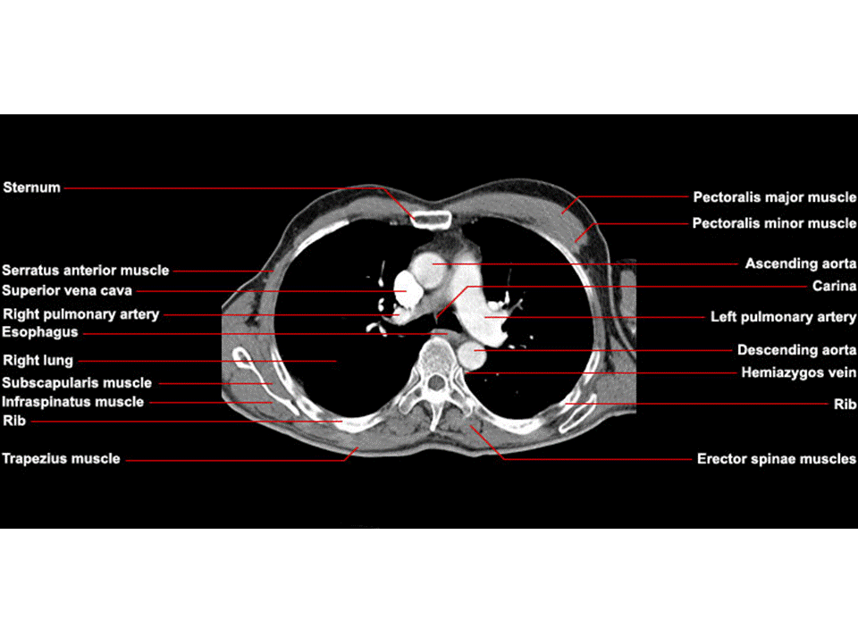 CT of the Chest Soft Tissue Windows Axial Anatomy – RADIOLOGYPICS.COM