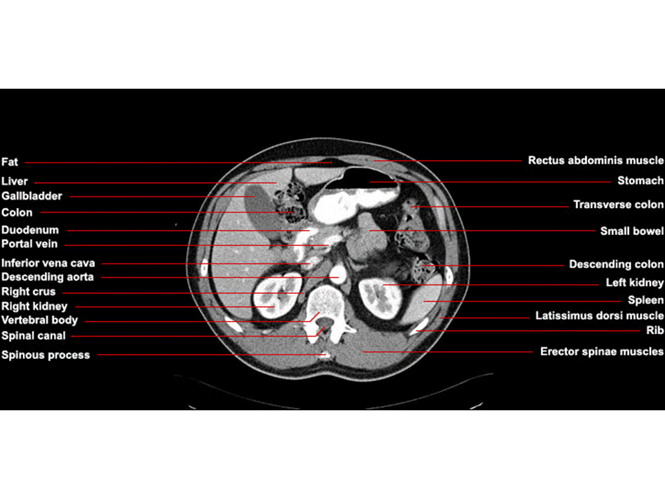 CT of the Abdomen Axial Anatomy – RADIOLOGYPICS.COM