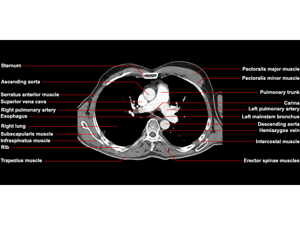 Ct Anatomy Chest
