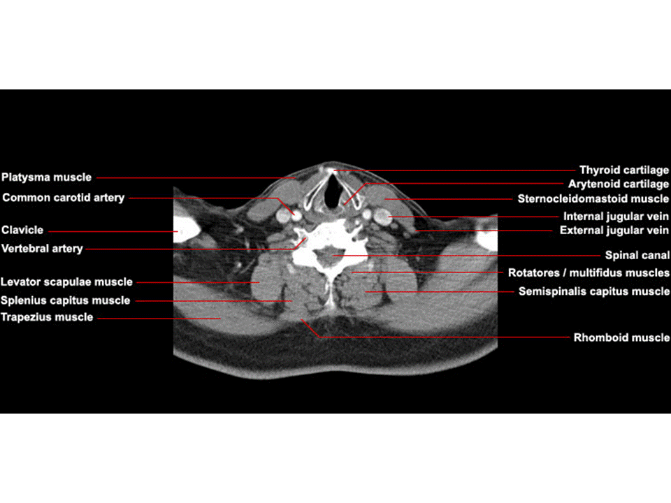 CT Neck Axial Anatomy – RADIOLOGYPICS.COM