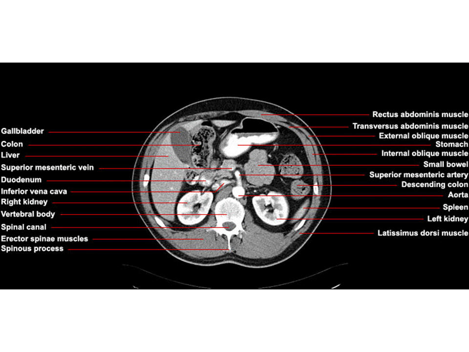 CT of the Abdomen Axial Anatomy – RADIOLOGYPICS.COM