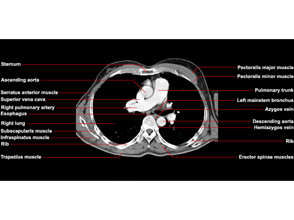 CT of the Chest Soft Tissue Windows Axial Anatomy – RADIOLOGYPICS.COM