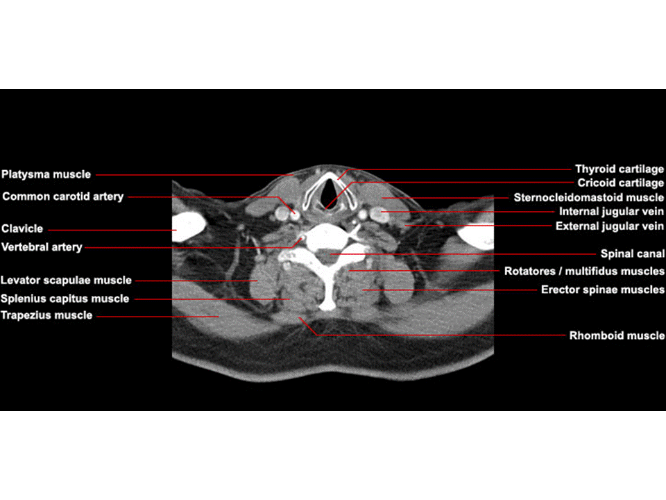 CT Neck Axial Anatomy – RADIOLOGYPICS.COM