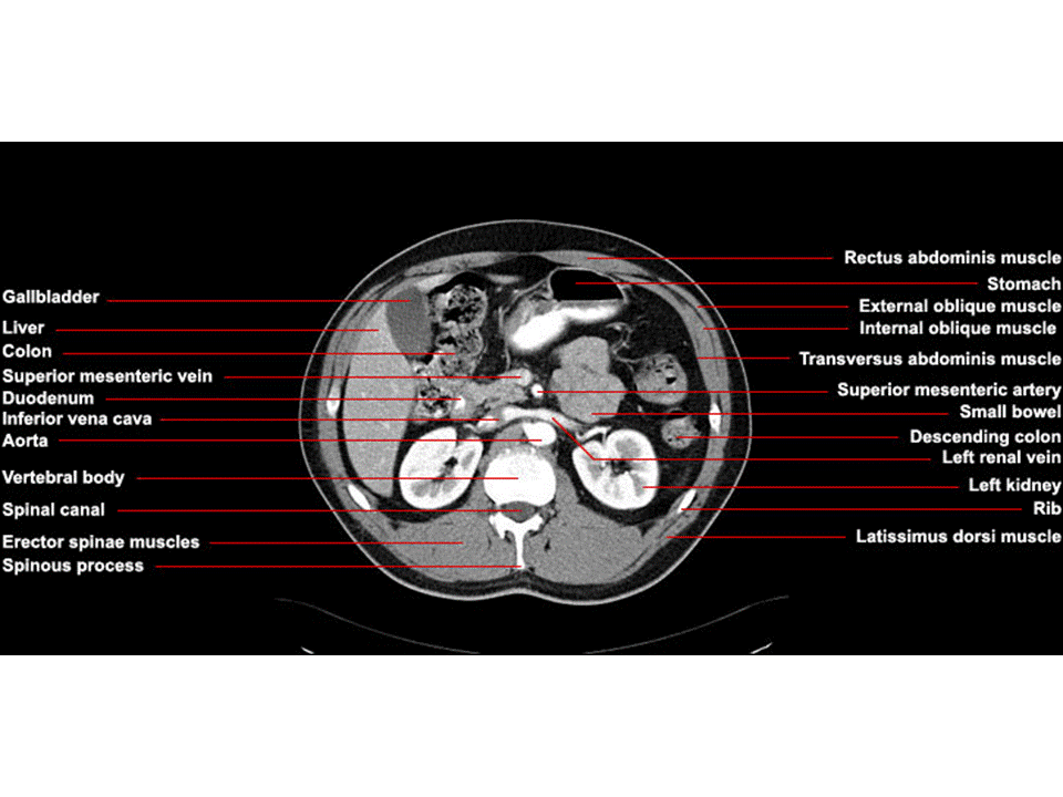 CT of the Abdomen Axial Anatomy – RADIOLOGYPICS.COM