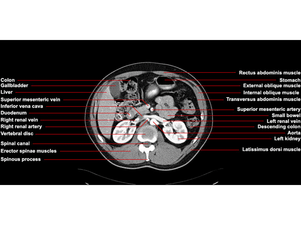 CT of the Abdomen Axial Anatomy – RADIOLOGYPICS.COM