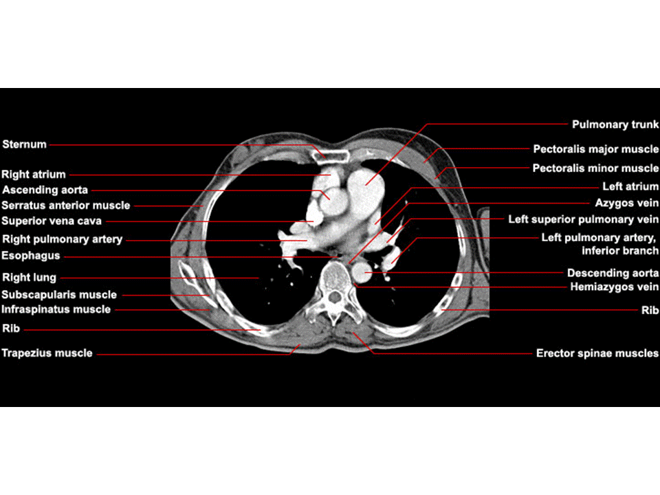 CT of the Chest Soft Tissue Windows Axial Anatomy – RADIOLOGYPICS.COM