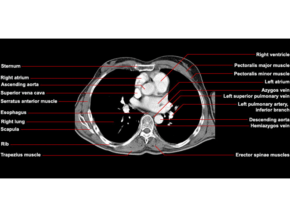 CT of the Chest Soft Tissue Windows Axial Anatomy – RADIOLOGYPICS.COM