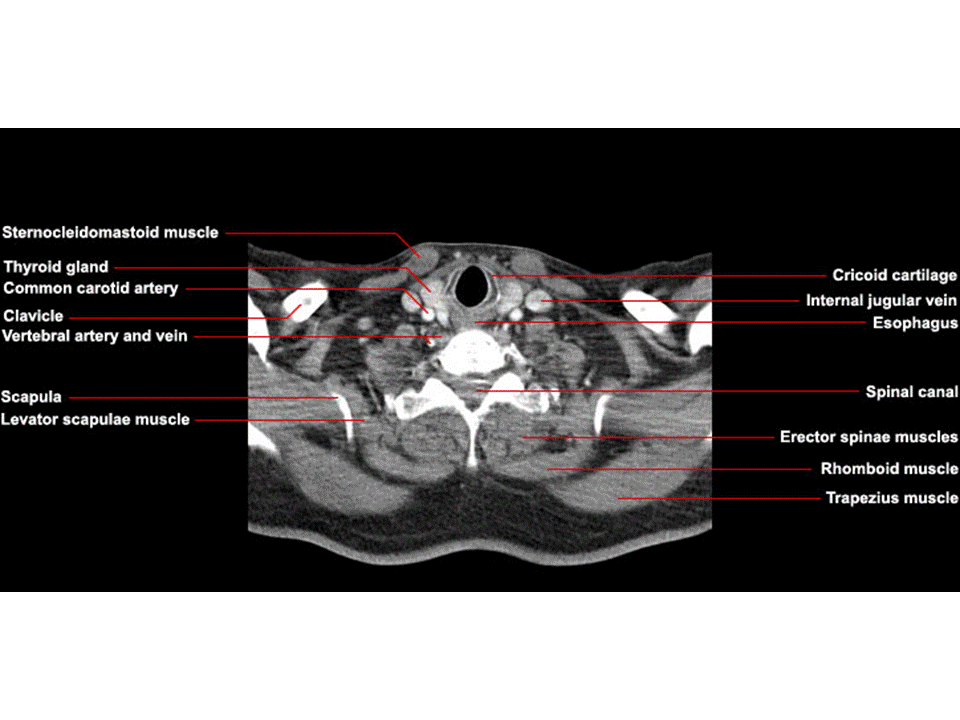 CT Neck Axial Anatomy – RADIOLOGYPICS.COM