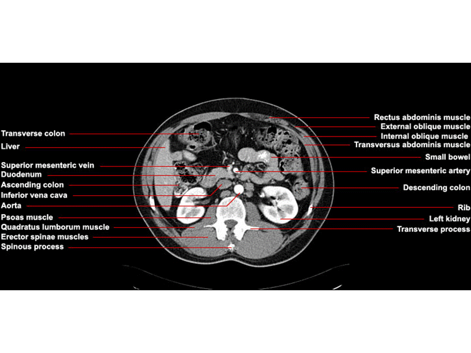 CT of the Abdomen Axial Anatomy – RADIOLOGYPICS.COM