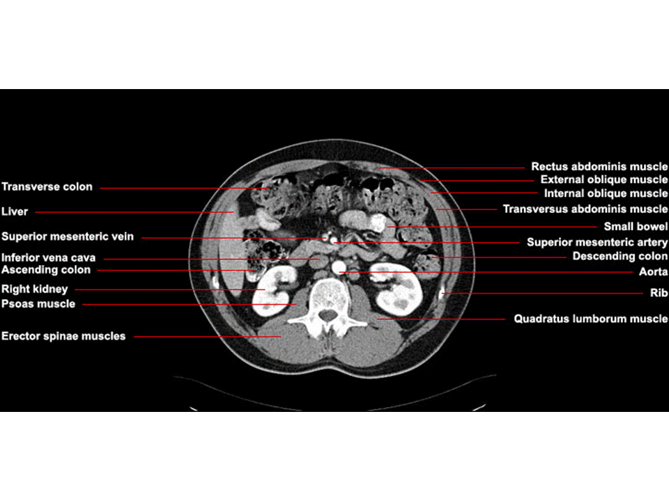 CT of the Abdomen Axial Anatomy – RADIOLOGYPICS.COM