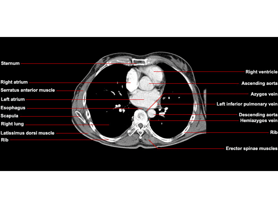 CT of the Chest Soft Tissue Windows Axial Anatomy – RADIOLOGYPICS.COM