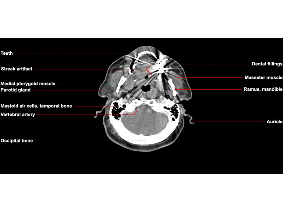 Ct Anatomy Of The Neck